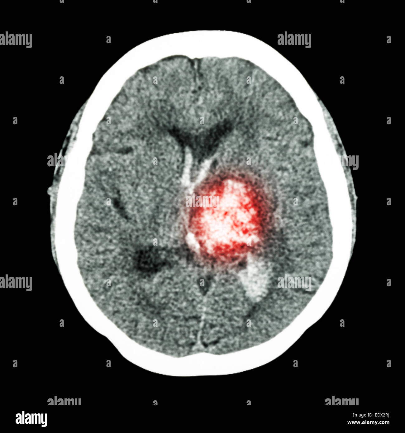 CT brain : show left thalamic hemorrhage (Hemorrhagic stroke Stock ...
