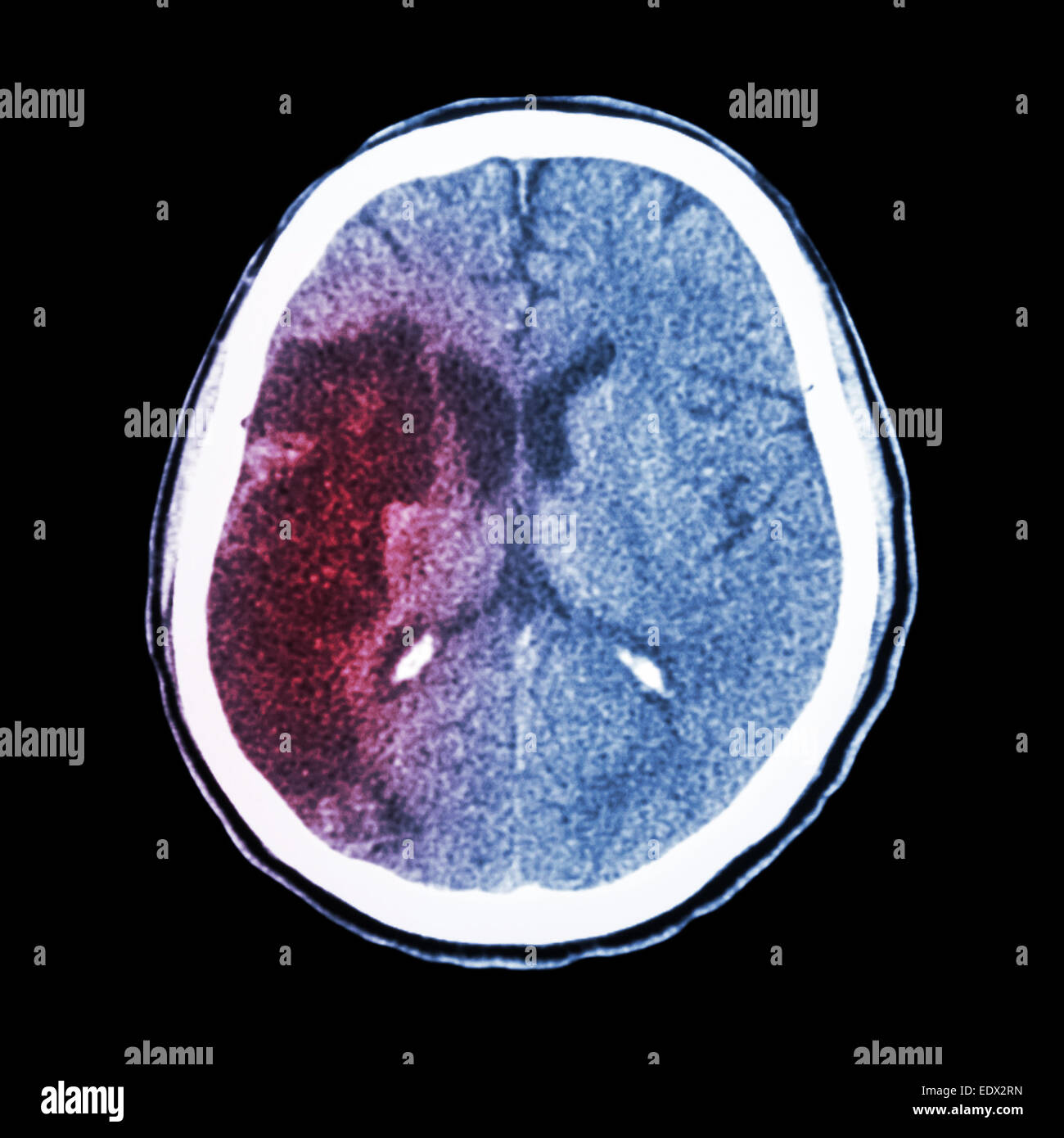 CT brain : show Ischemic stroke (hypodensity at right frontal-parietal ...