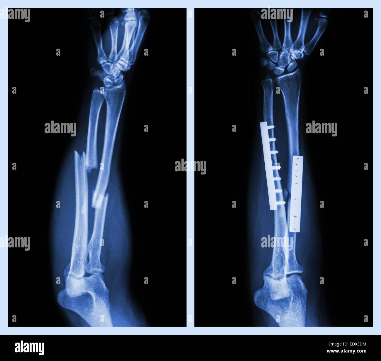 Fracture both bone of forearm. It was operated and internal fixed with ...