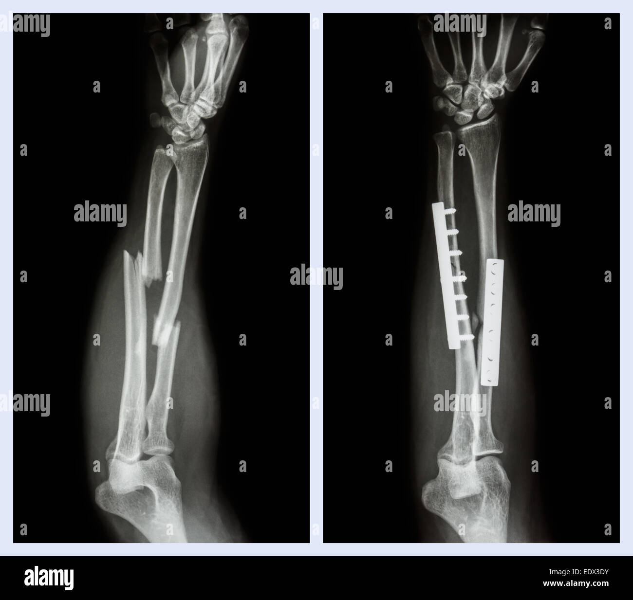Fracture both bone of forearm. It was operated and internal fixed with ...