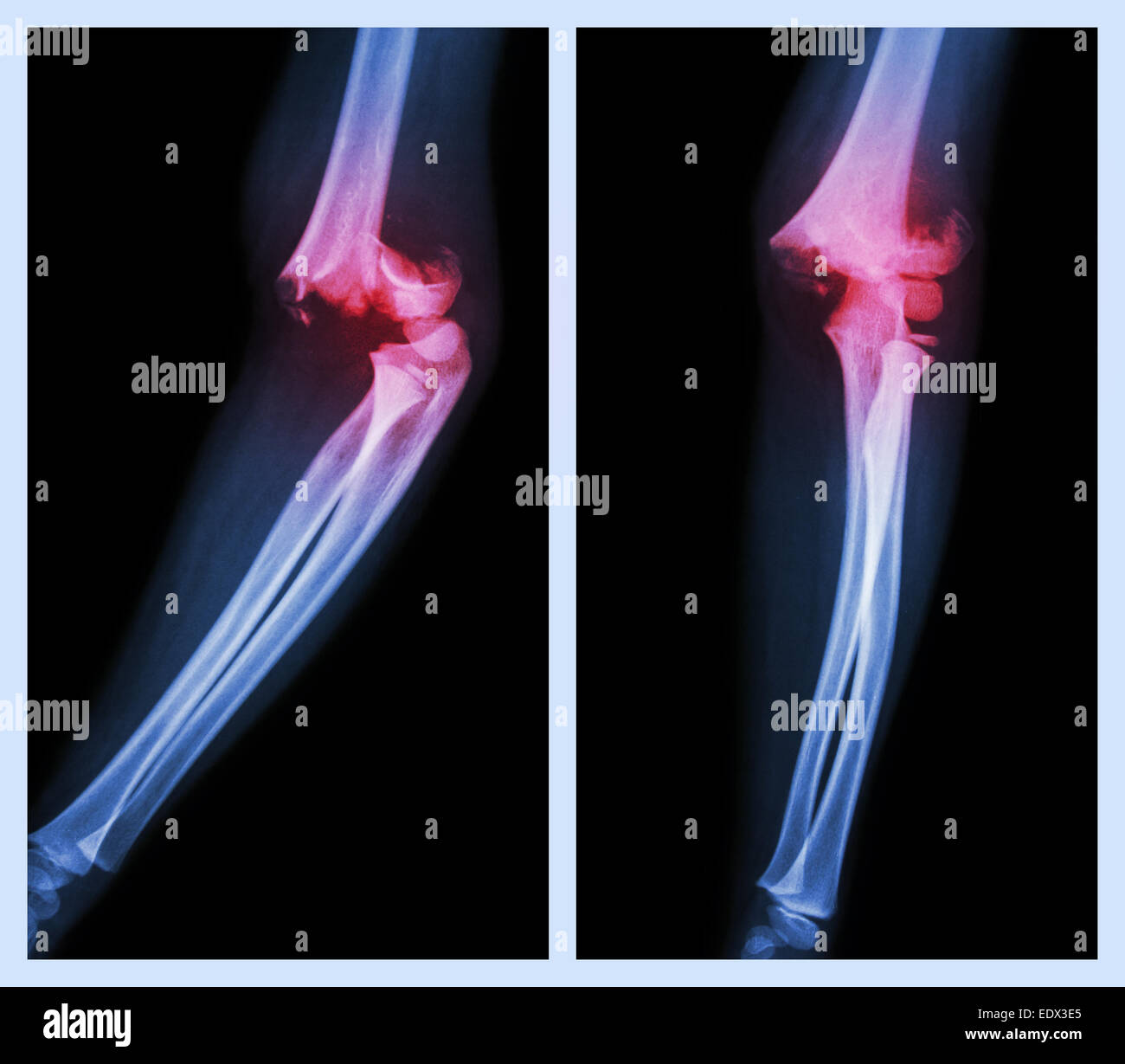 Broken elbow hi-res stock photography and images - Alamy