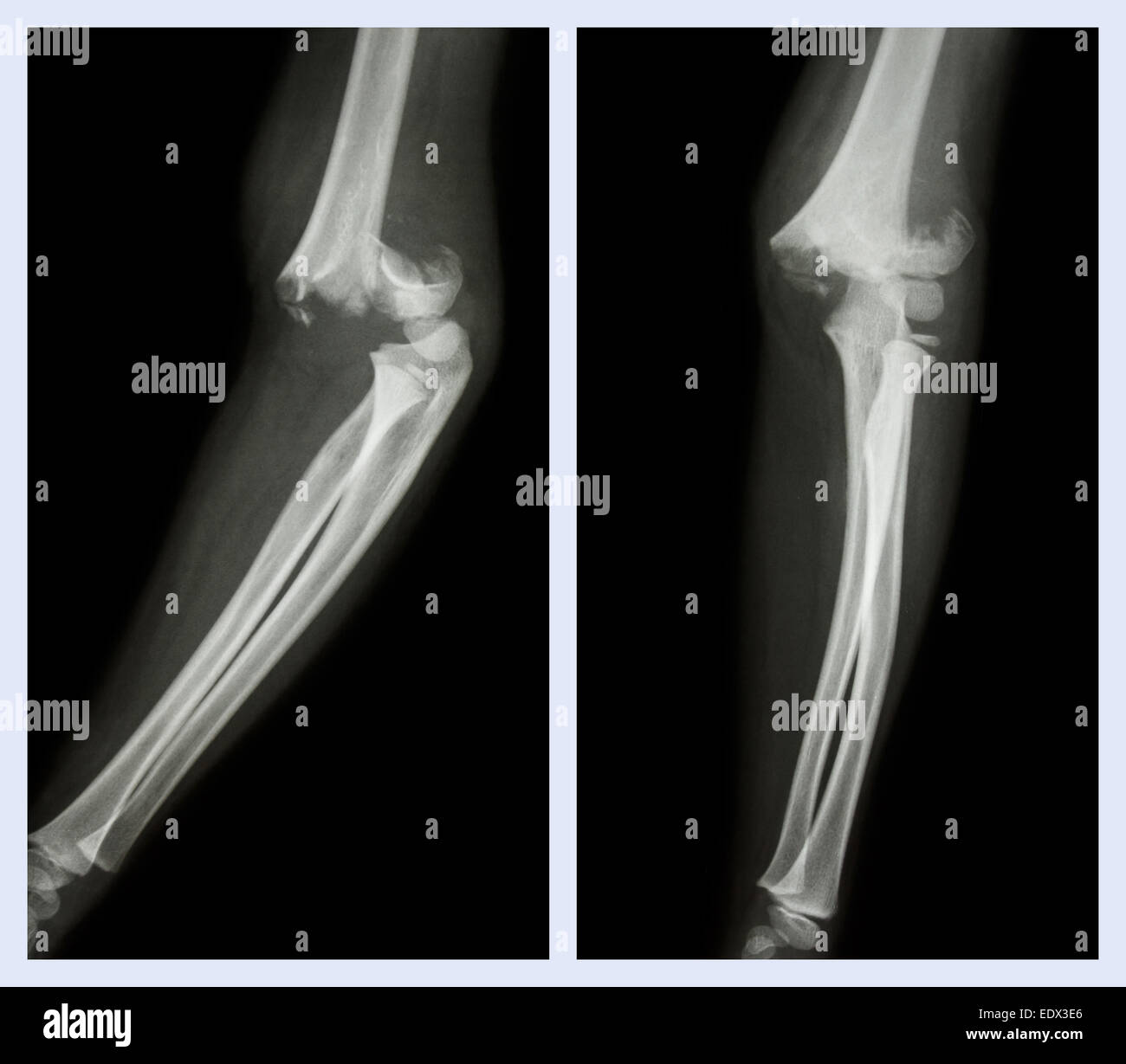 Elbow Fracture X Ray Images