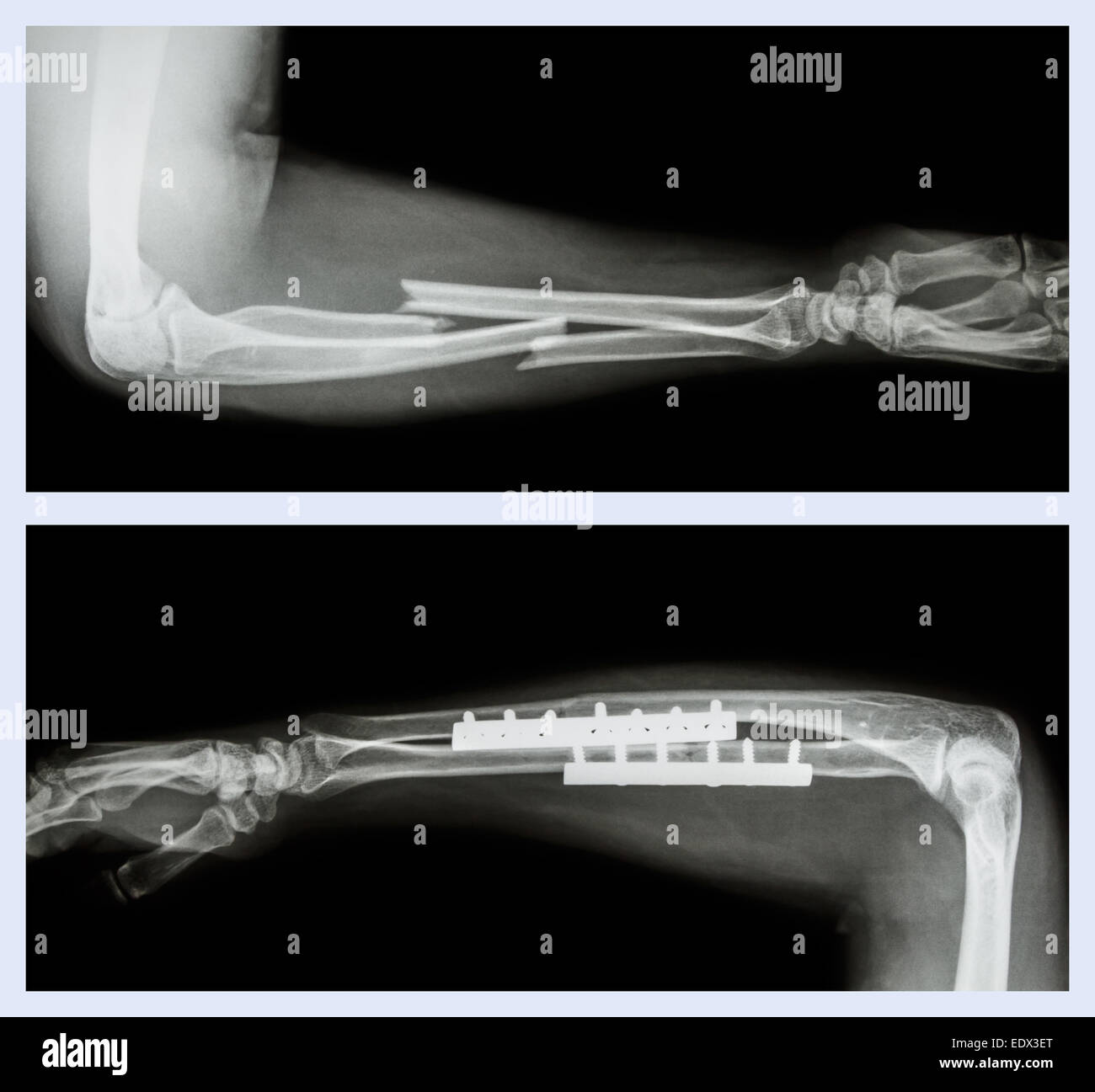 Lower arm bone hi-res stock photography and images - Alamy