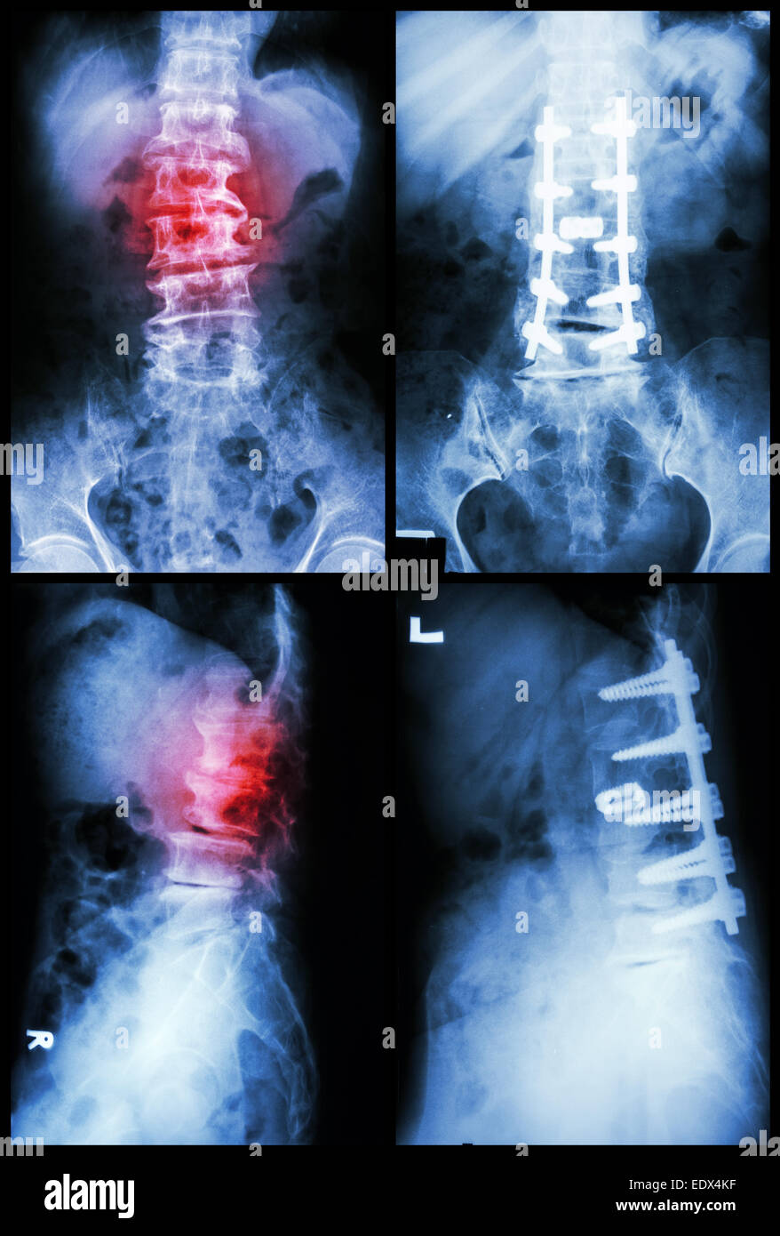 "Spondylosis and Spondylolisthesis" It was operated and internal fixed ...