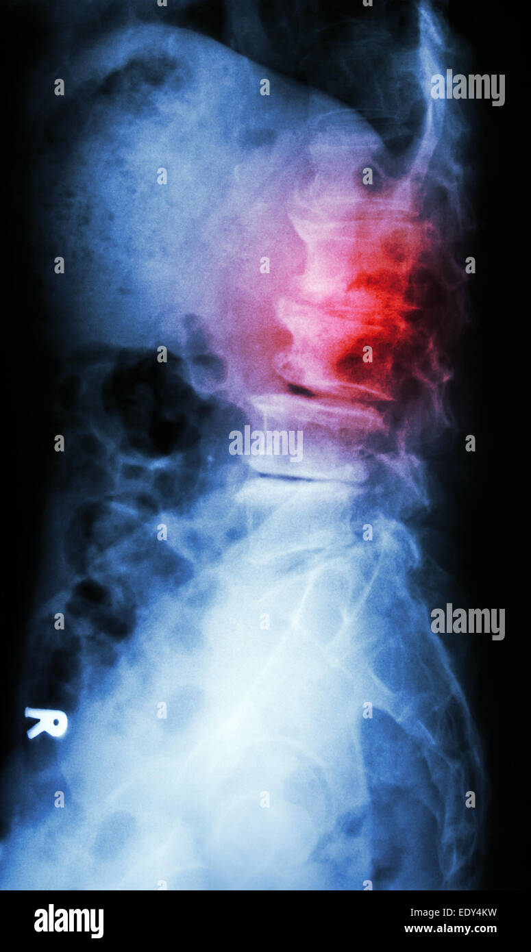 "Spondylolisthesis" film x-ray L-S spine lateral (lumbar-sacrum) of old ...