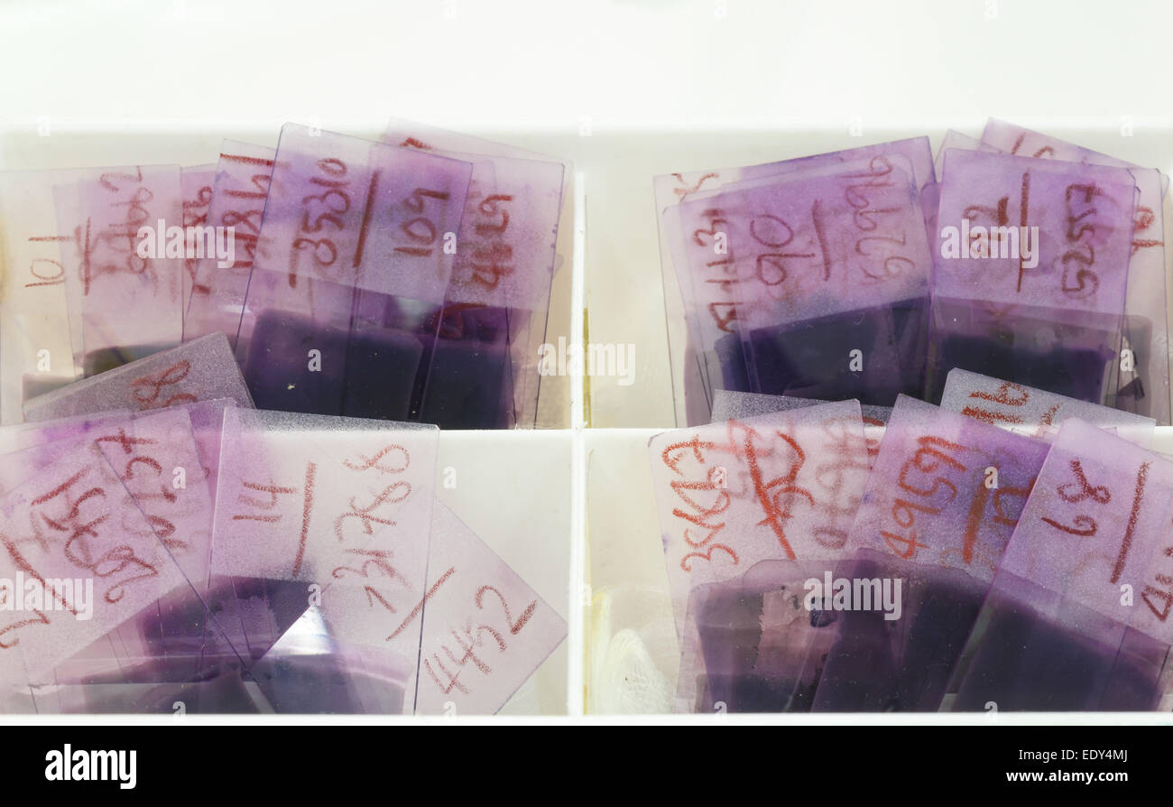 Blood smear hi-res stock photography and images - Alamy