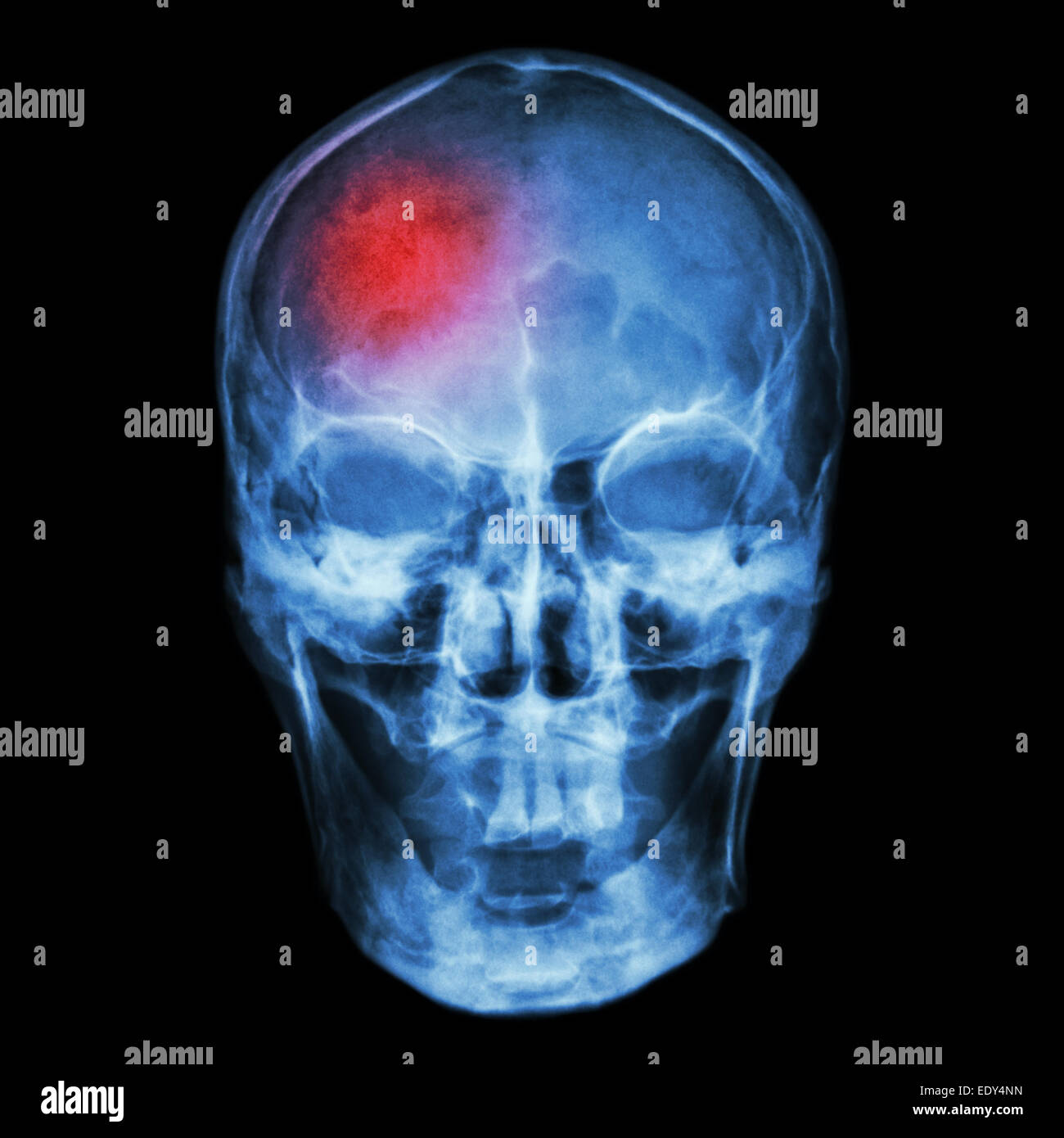 Stroke patient hospital hi-res stock photography and images - Alamy