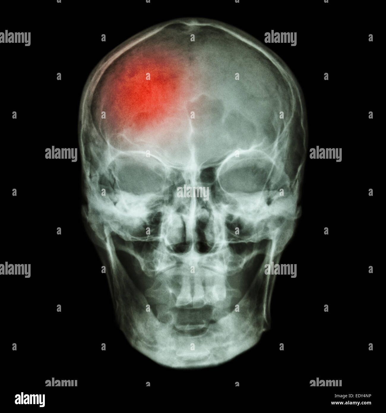 Stroke patient hospital hi-res stock photography and images - Alamy