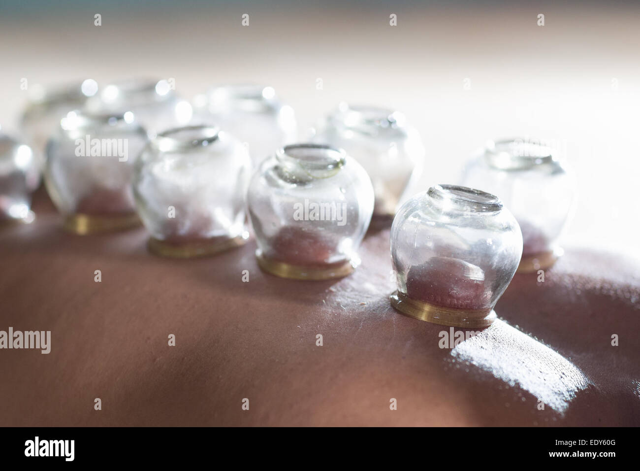 Cupping therapy hi-res stock photography and images - Alamy