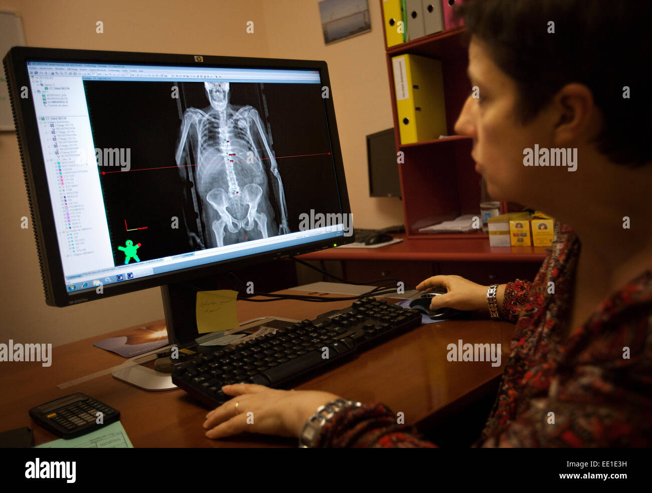 Intensity modulated radiation therapy hi-res stock photography and ...