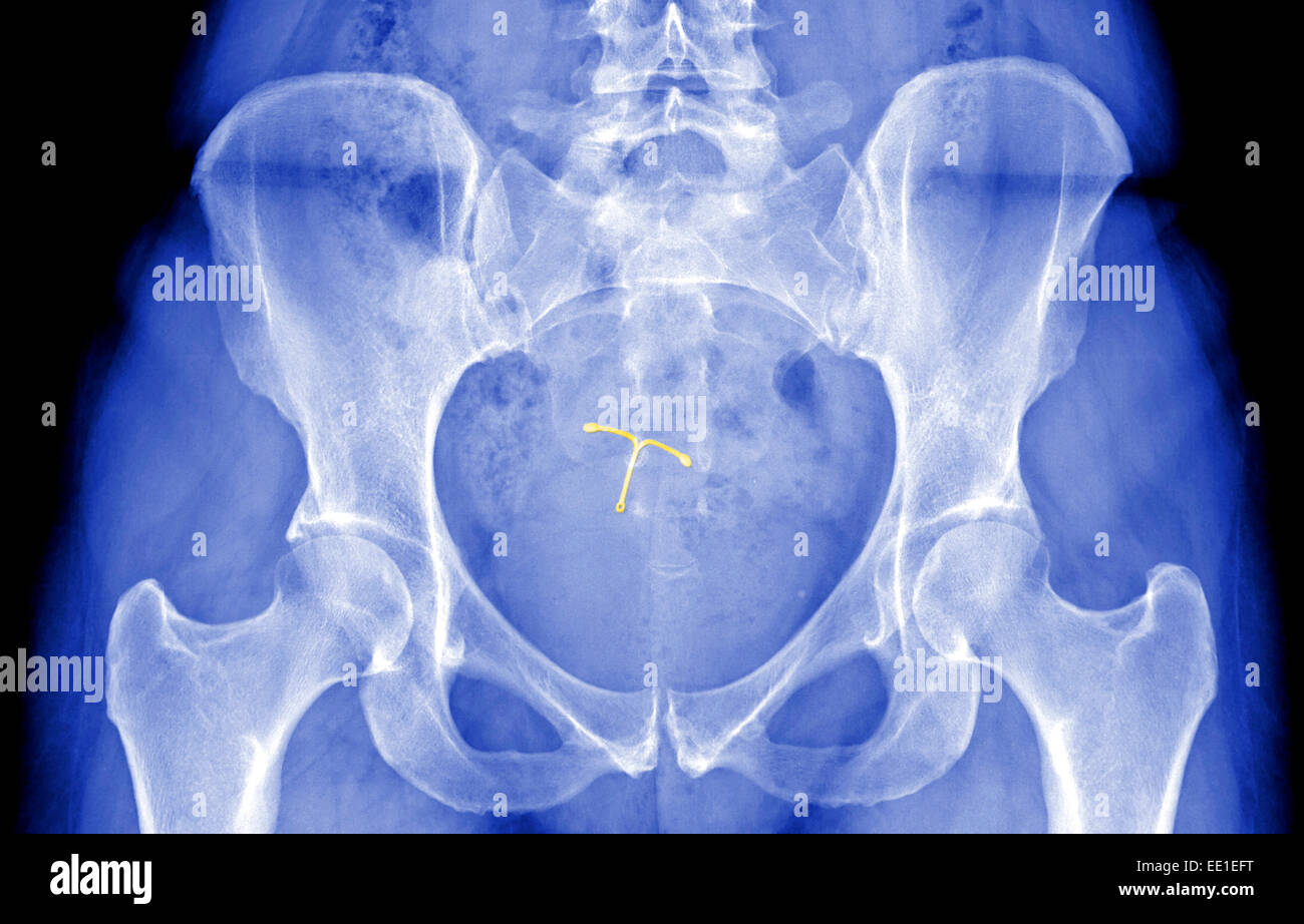 Gynecology iud hi-res stock photography and images - Alamy