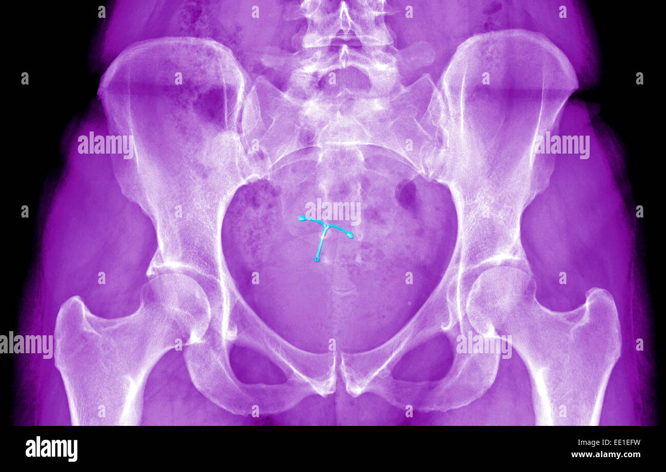 Intrauterine device hi-res stock photography and images - Alamy