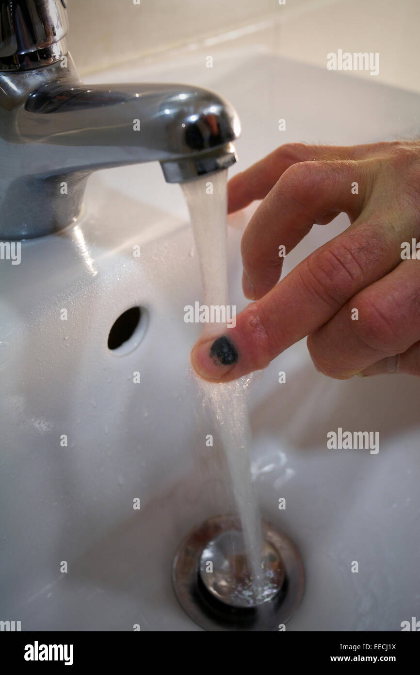 Holding an injured fingernail under a cold tap to reduce the bruising ...