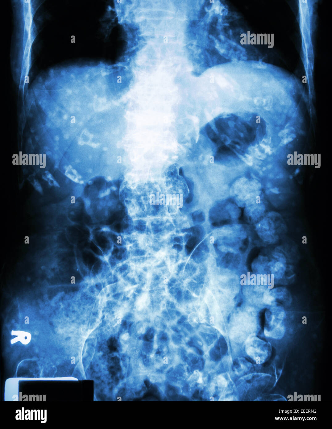 " Constipation " ( X-ray abdomen of old man : a lot of feces in large ...