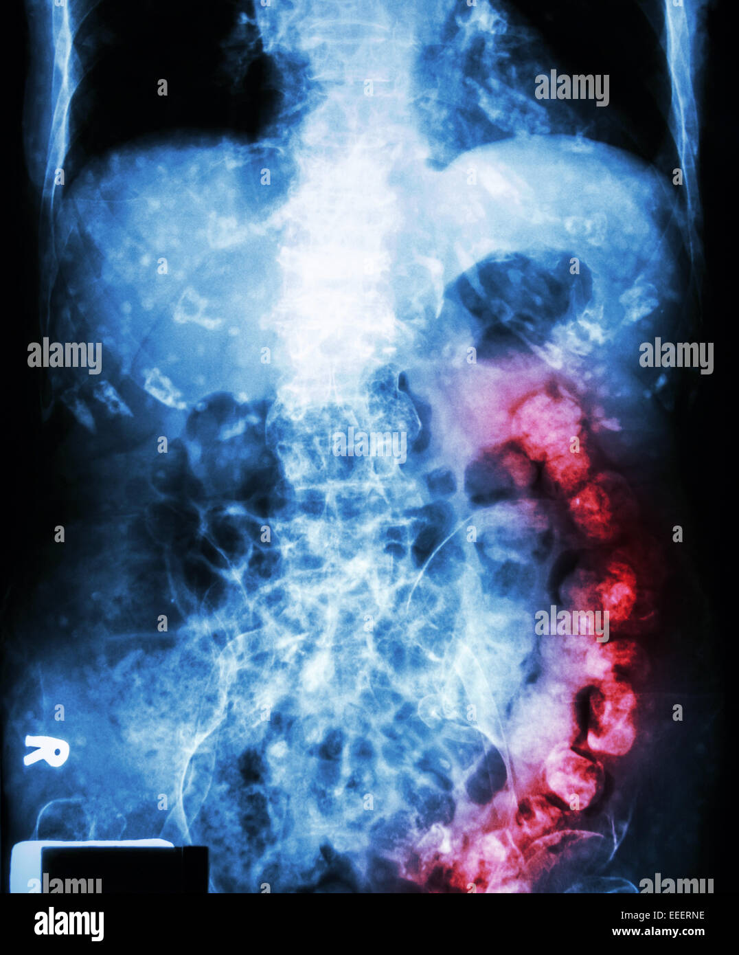 Intestine Xray Stock Photos & Intestine Xray Stock Images - Alamy