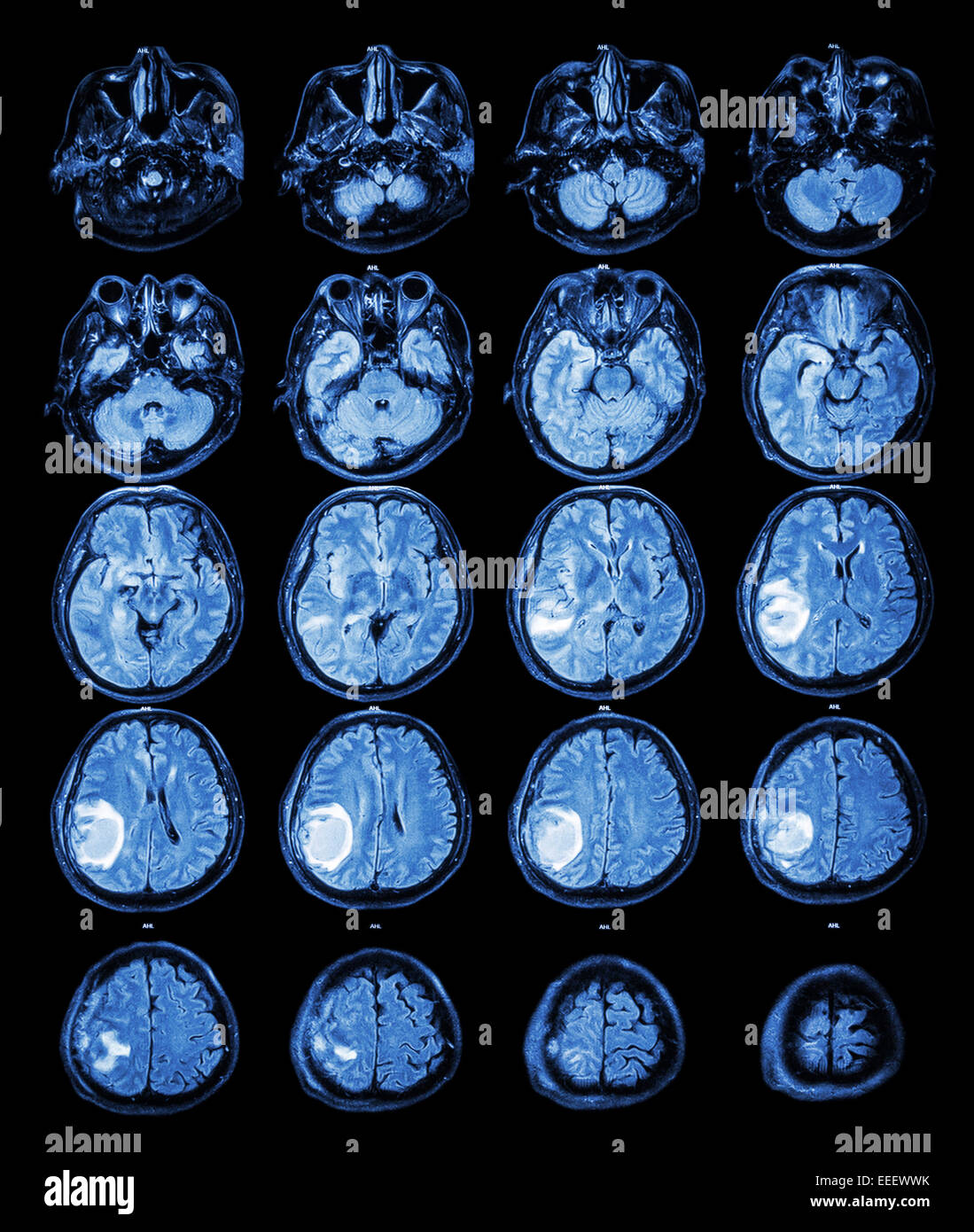 MRI brain : Brain tumor at right parietal lobe Stock Photo - Alamy