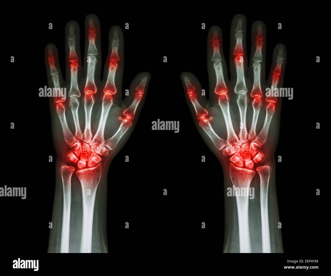 Arthritis Hands X Ray