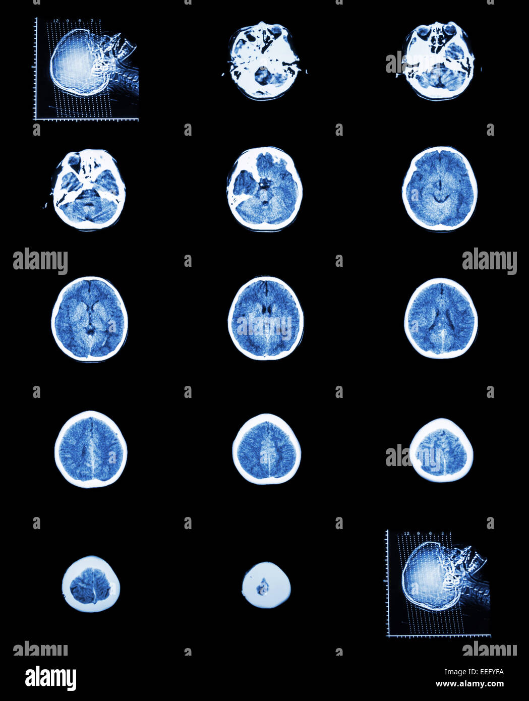 Computed tomography ct scan brain hi-res stock photography and images - Alamy