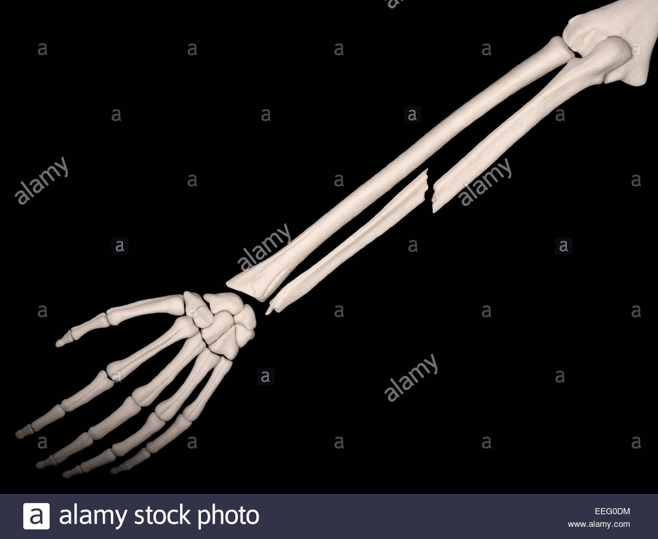 Fractured Ulna Stock Photos & Fractured Ulna Stock Images - Alamy