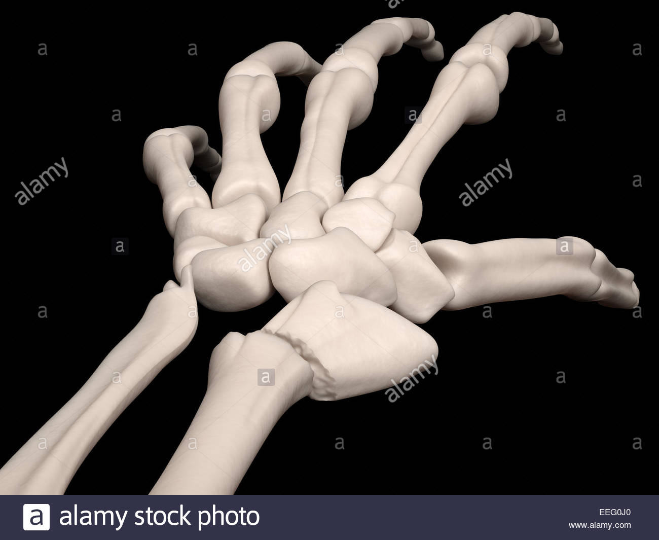 Colles Wrist Fracture Stock Photos & Colles Wrist Fracture Stock Images ...