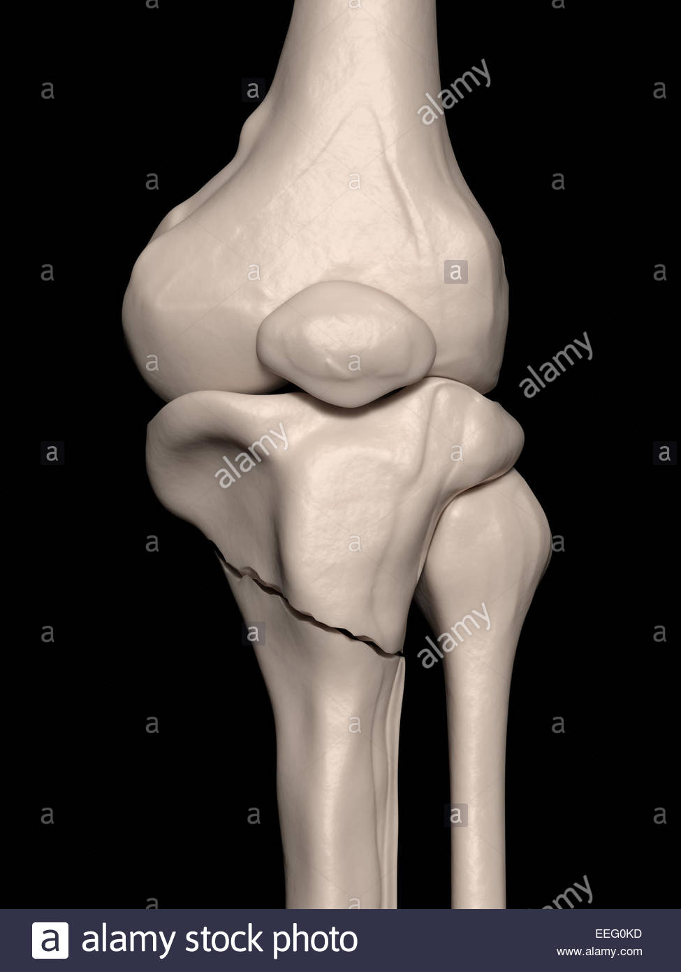 Fracture Of The Leg High Resolution Stock Photography and Images - Alamy