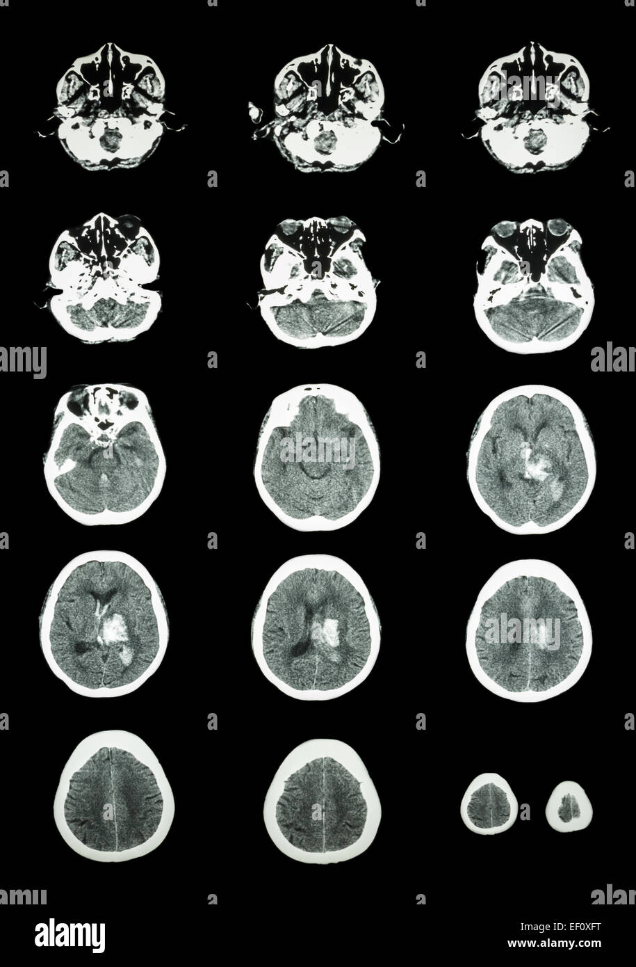 Hemorrhagic Stroke . CT scan (computed tomography) of brain ( cerebrovascular system ...