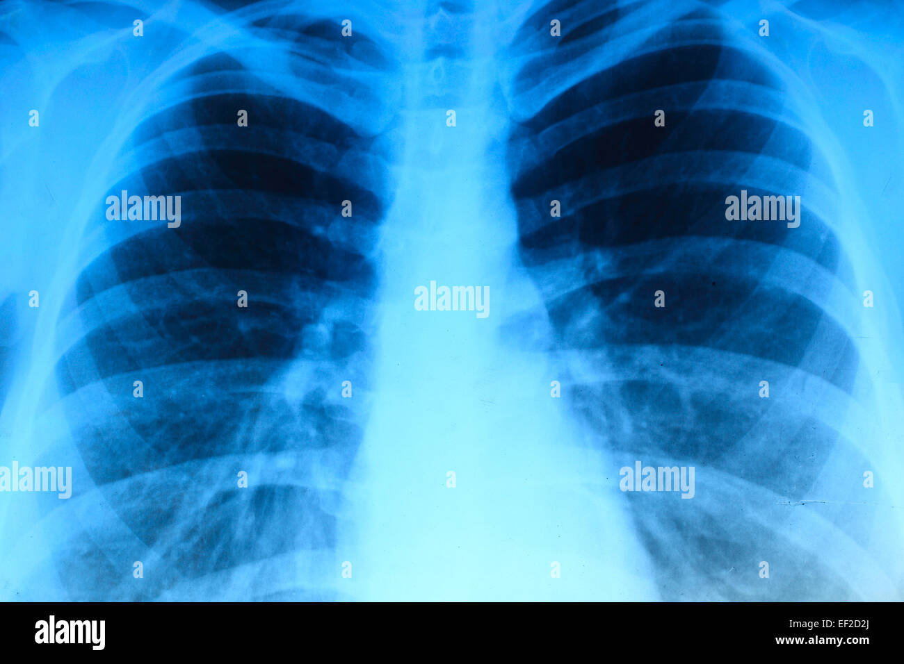 X-ray image of chest bones of adult, abstract blue background Stock ...