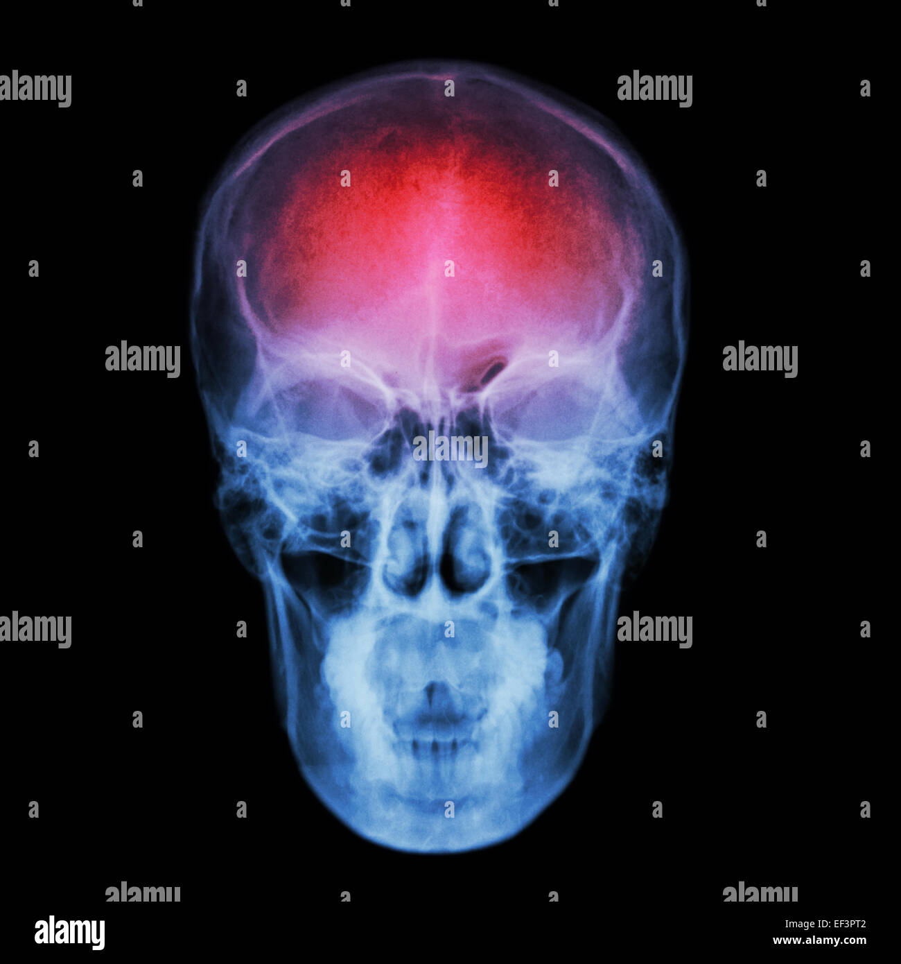 Cerebrovascular accident hi-res stock photography and images - Alamy