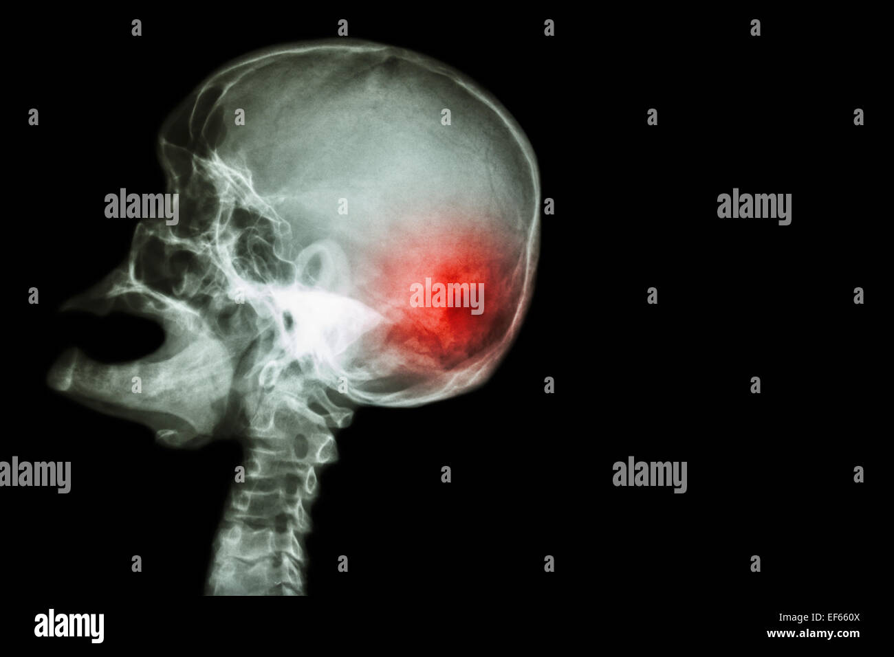 X-ray skull open mouth ( side view ) and Stroke ( Cerebrovascular ...