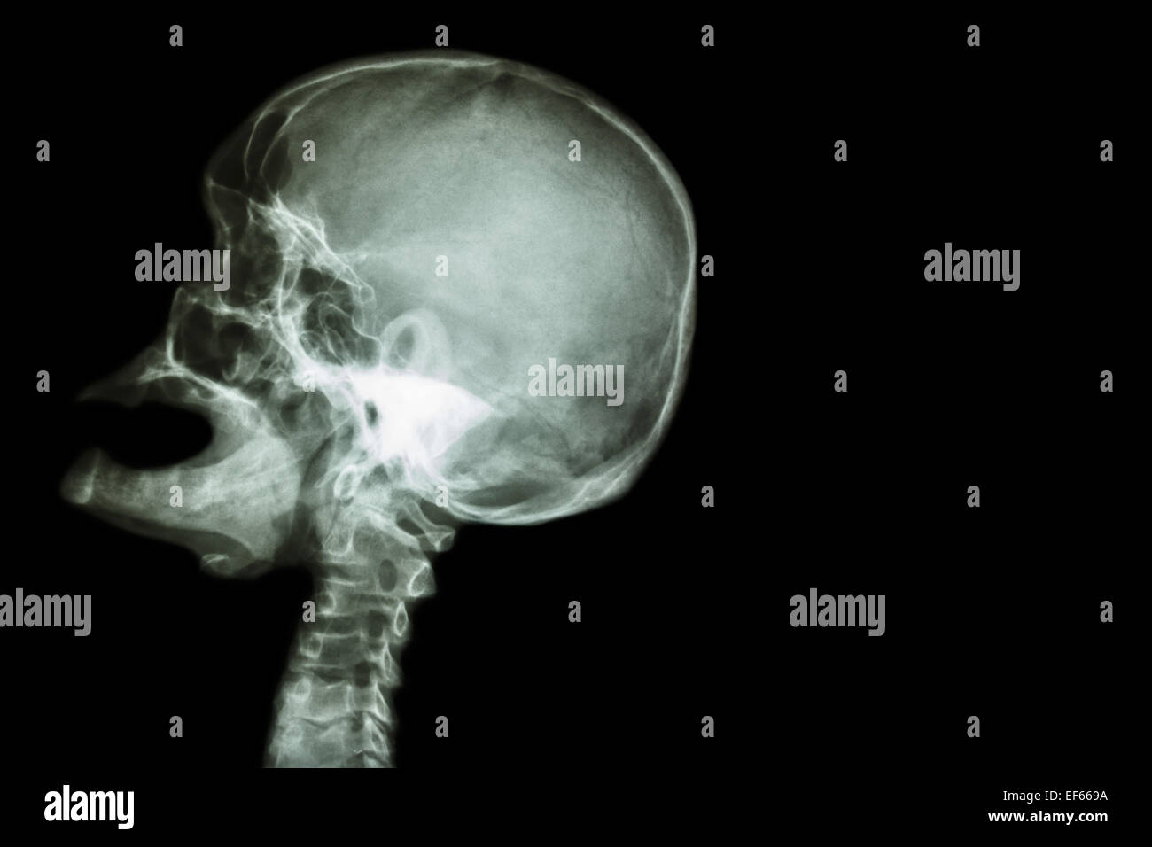 X-ray skull open mouth ( side view ) and Stroke ( Cerebrovascular ...