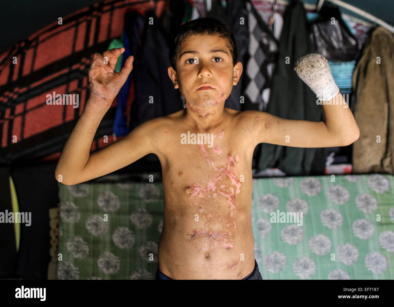 Shyar Ahmed 14 years old of Kobani shows his cut left hand and body ...