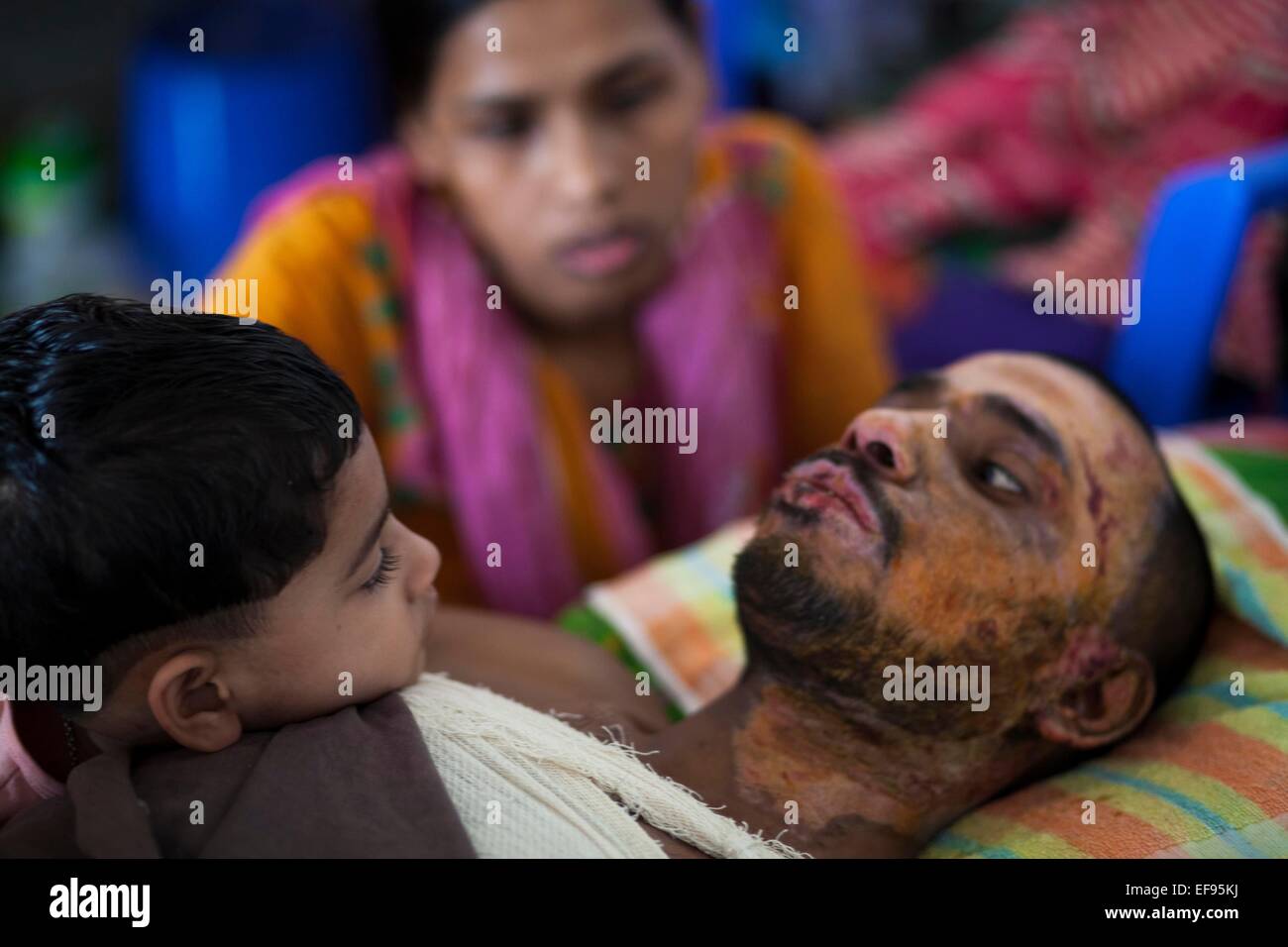 Burn victim child hi-res stock photography and images - Alamy