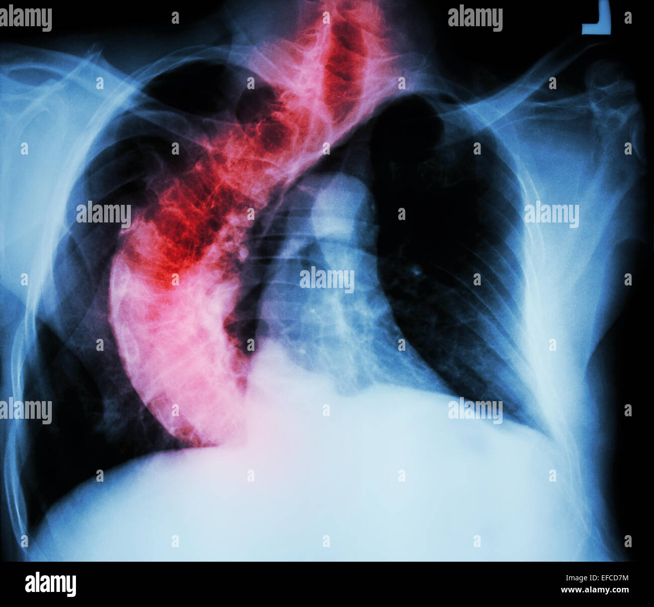 Scoliosis ( crooked spine ) X-ray chest of old people with crooked ...