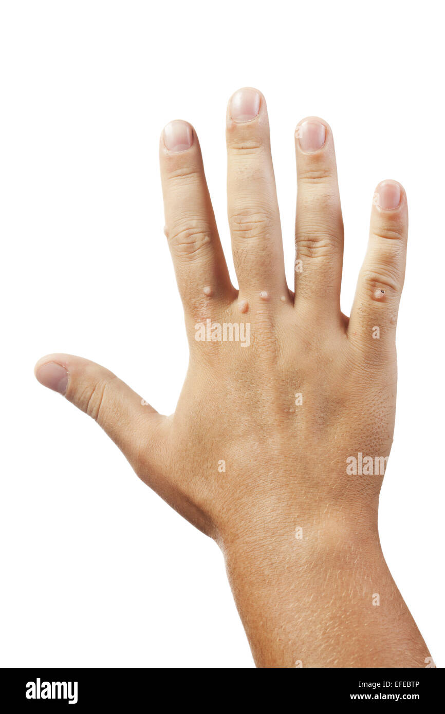 hand with warts isolated on white background Stock Photo - Alamy