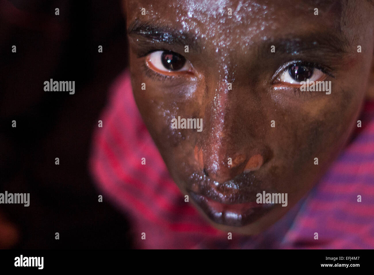 Burn Victim Child High Resolution Stock Photography and Images - Alamy
