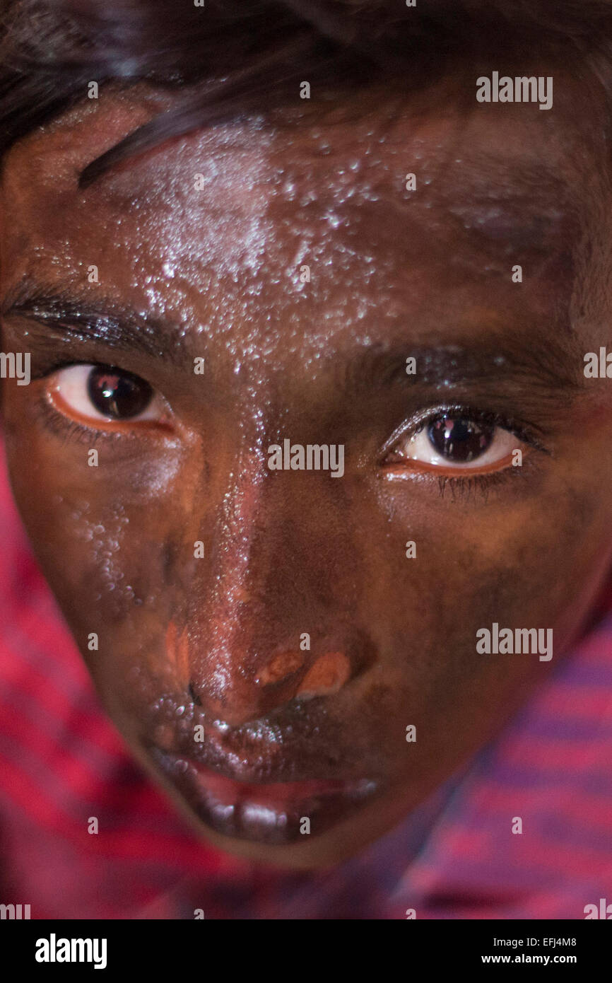 Burn victim child hi-res stock photography and images - Alamy