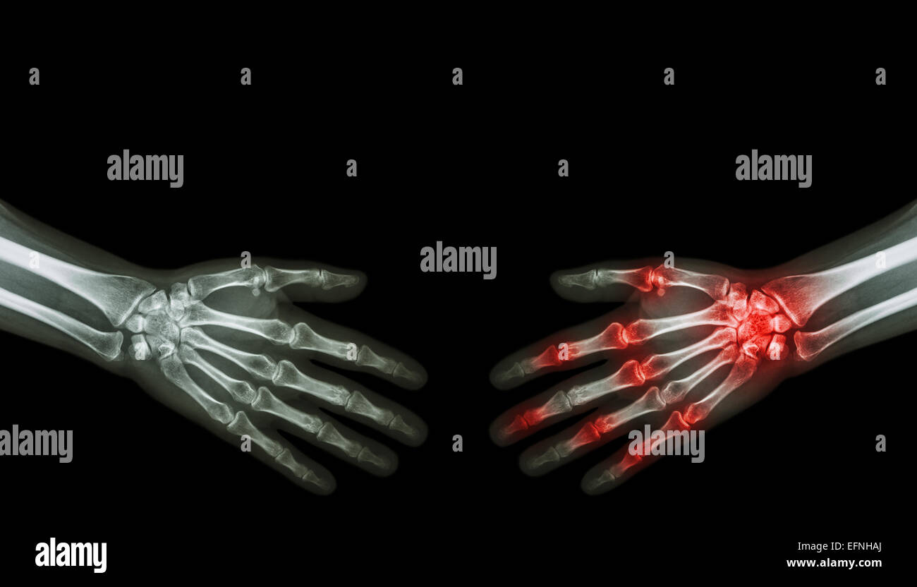 X ray normal hand hi-res stock photography and images - Alamy