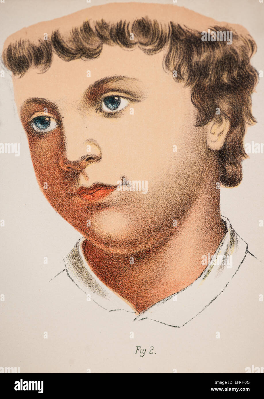 Scarlet Fever illustration, circa 1912 Stock Photo - Alamy