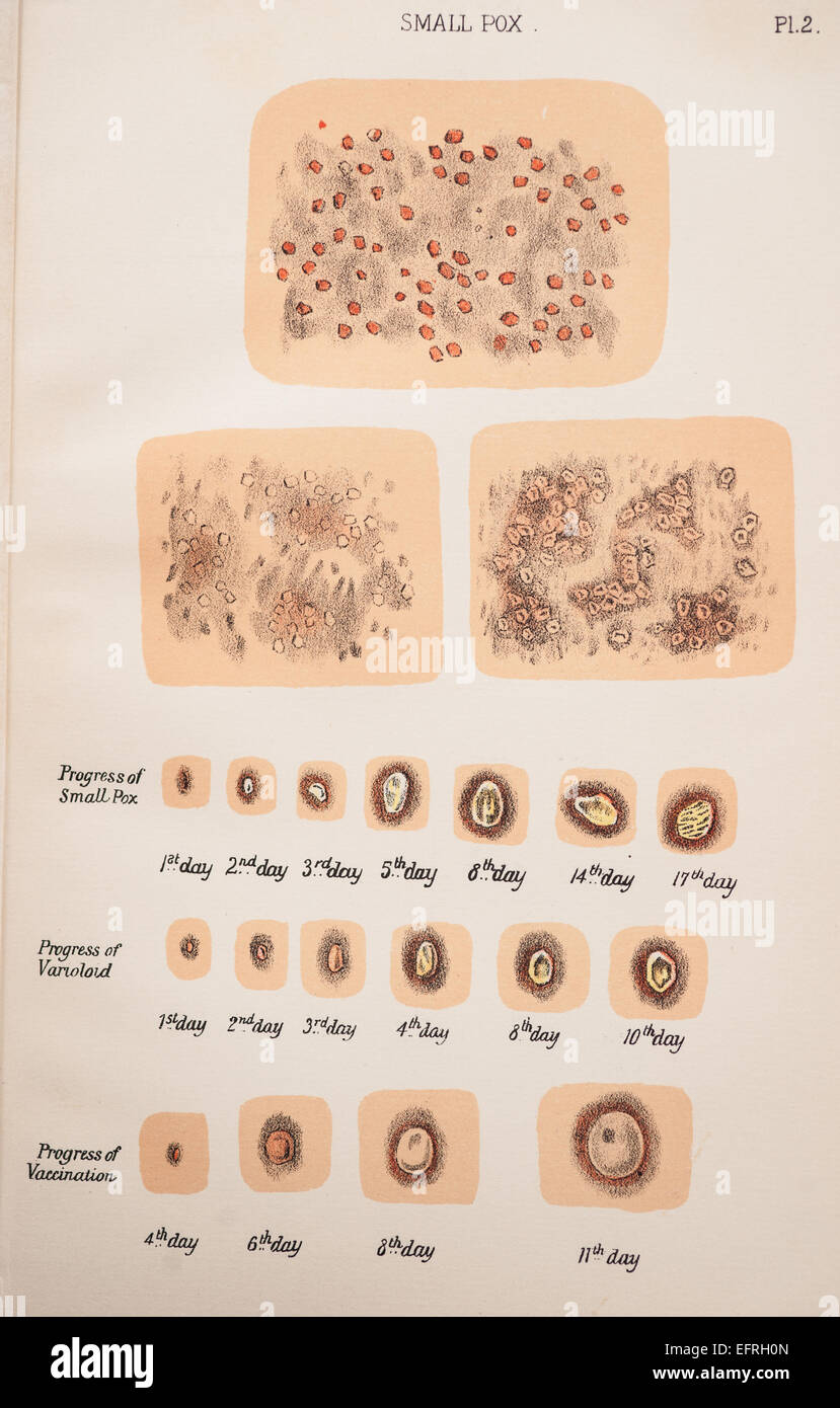 Antique small pox illustration, circa 1912 Stock Photo - Alamy