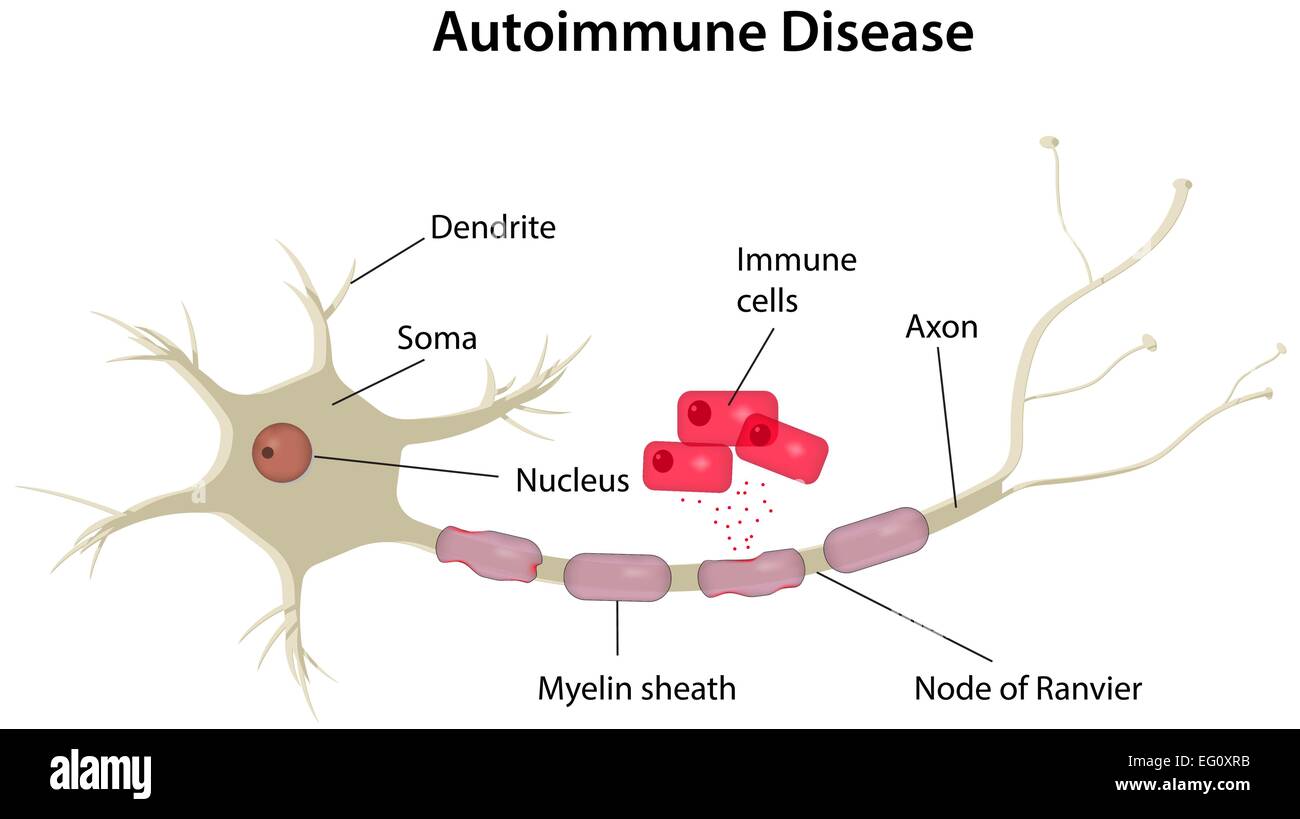 Autoimmune disease Stock Vector Images - Alamy