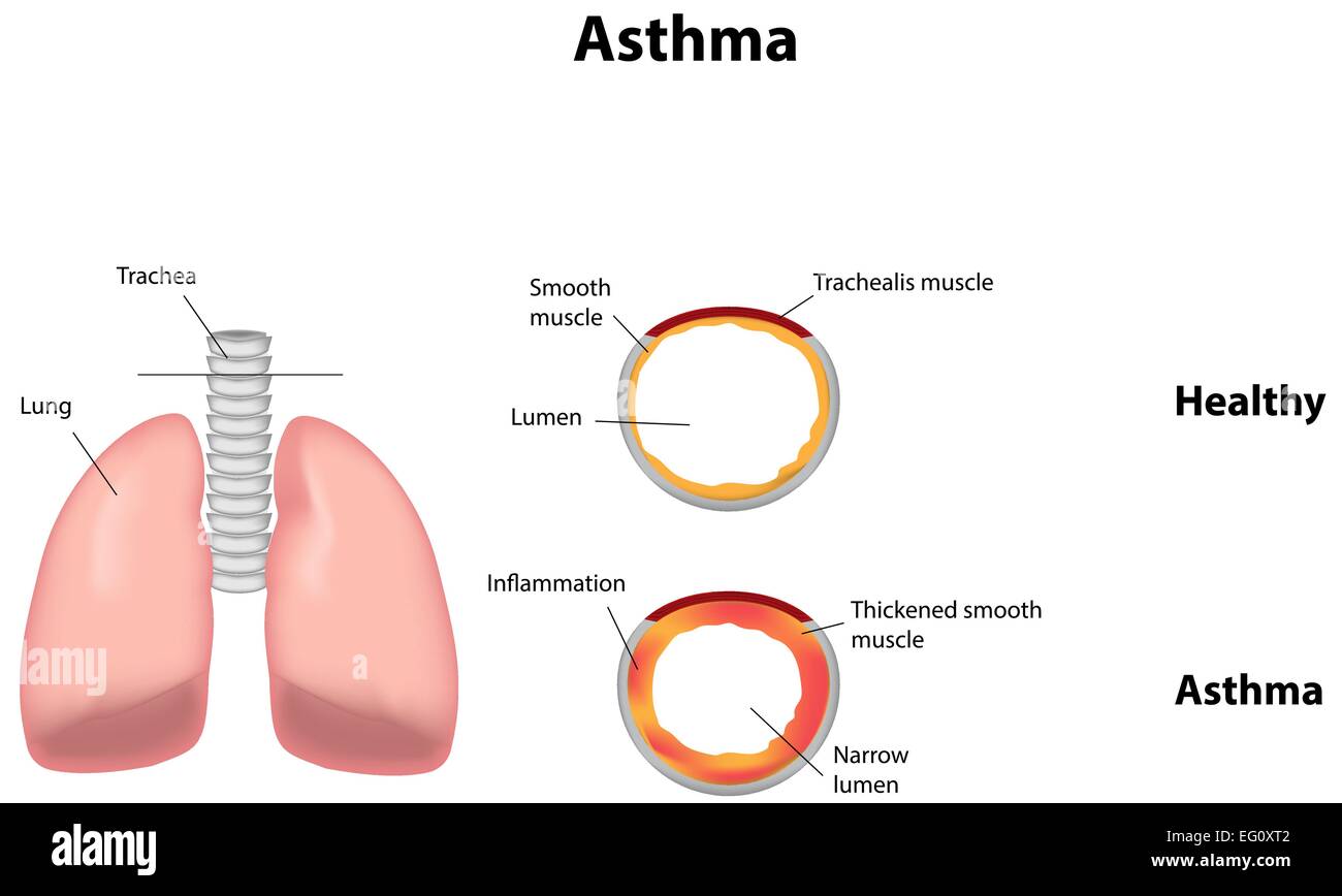 Asthmatic Stock Vector Images - Alamy