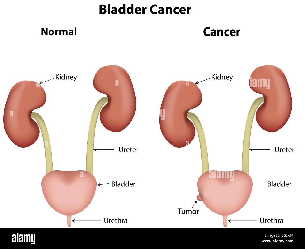 Bladder cancer hi-res stock photography and images - Alamy