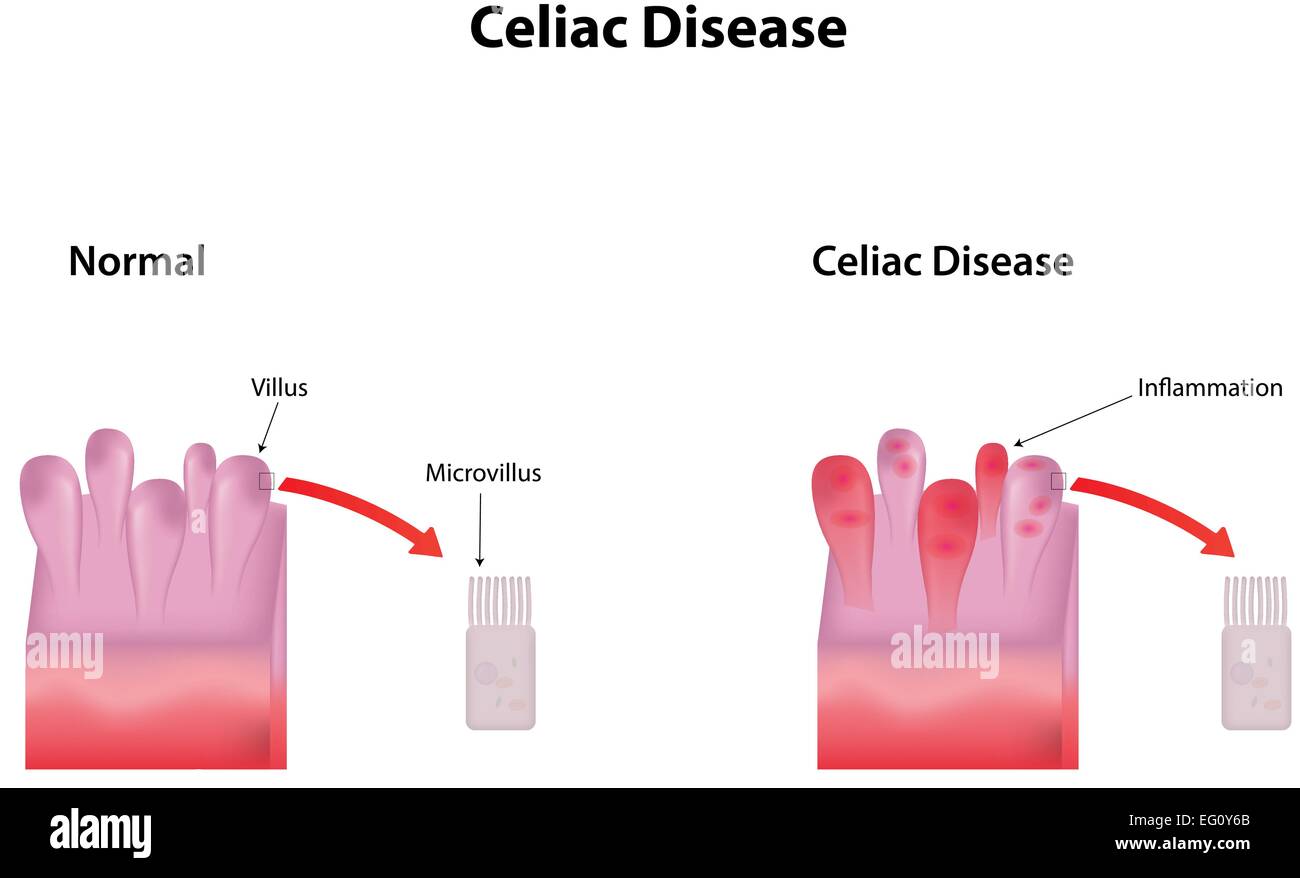 Celiac intestine hi-res stock photography and images - Alamy