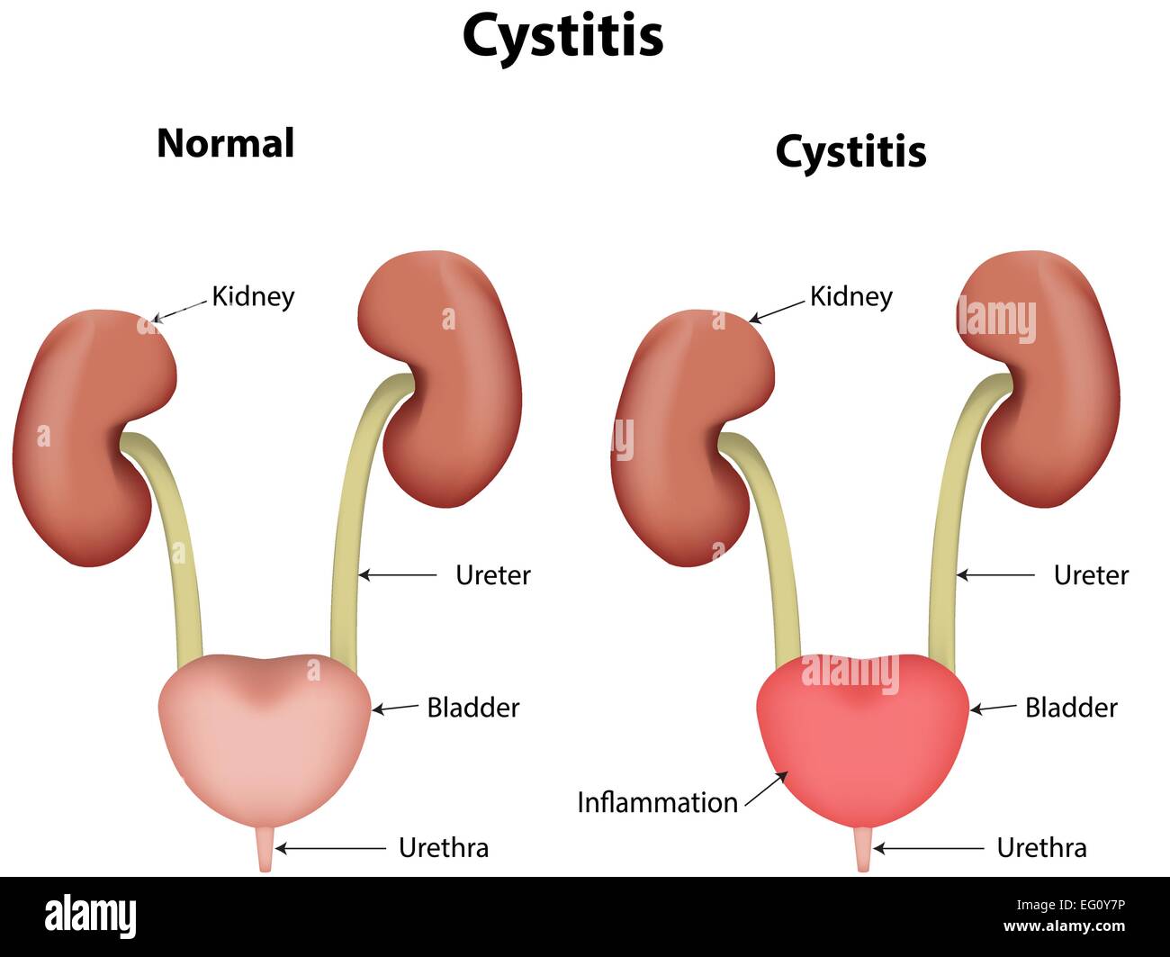Cystitis hi-res stock photography and images - Alamy