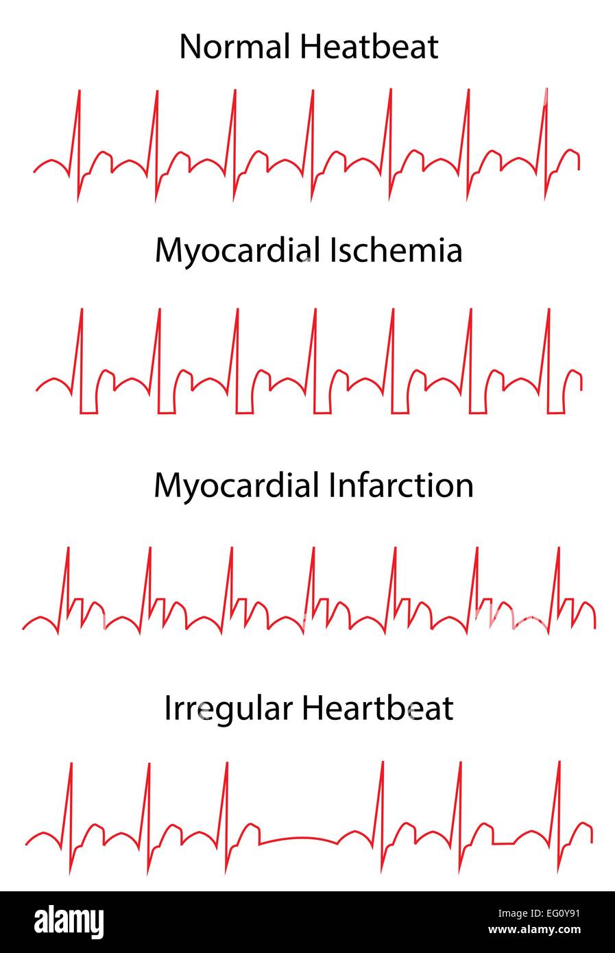 ECG and EKG Pathology Stock Vector Image & Art - Alamy