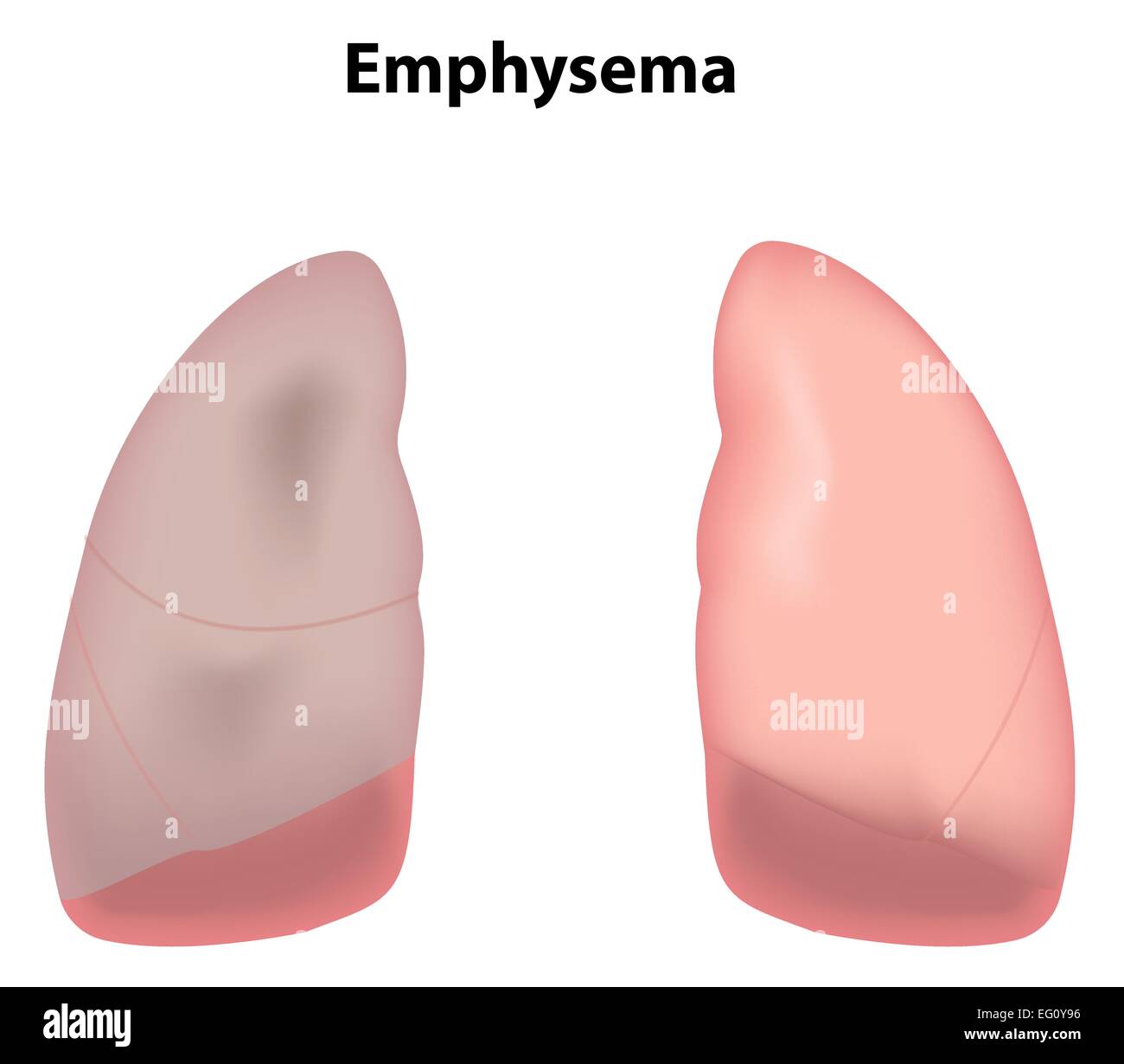 Emphysema Stock Vector Images - Alamy