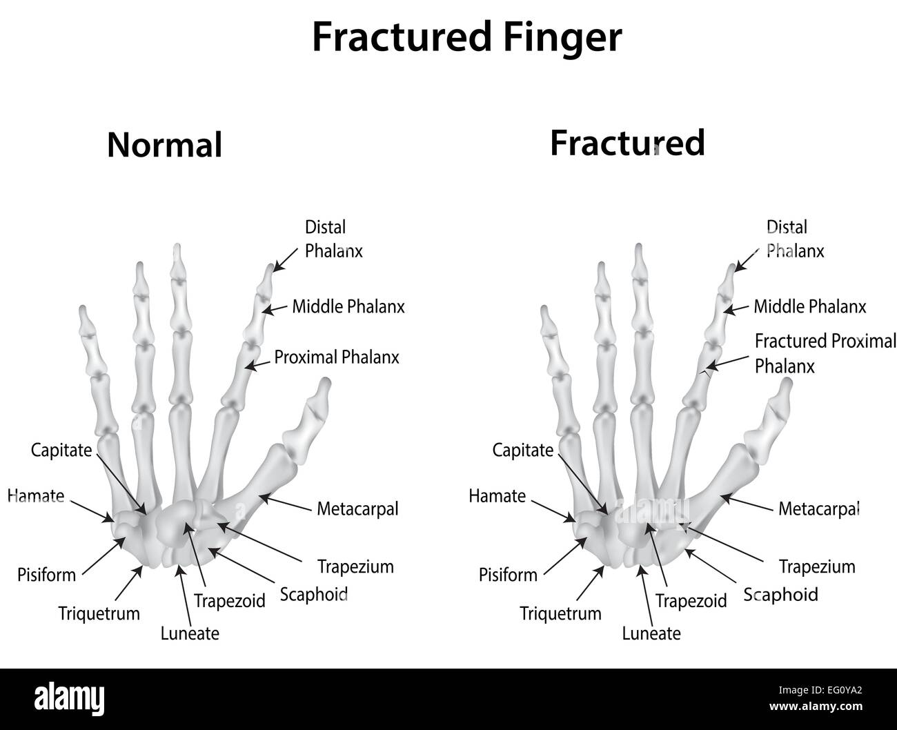 Fractured finger hi-res stock photography and images - Alamy