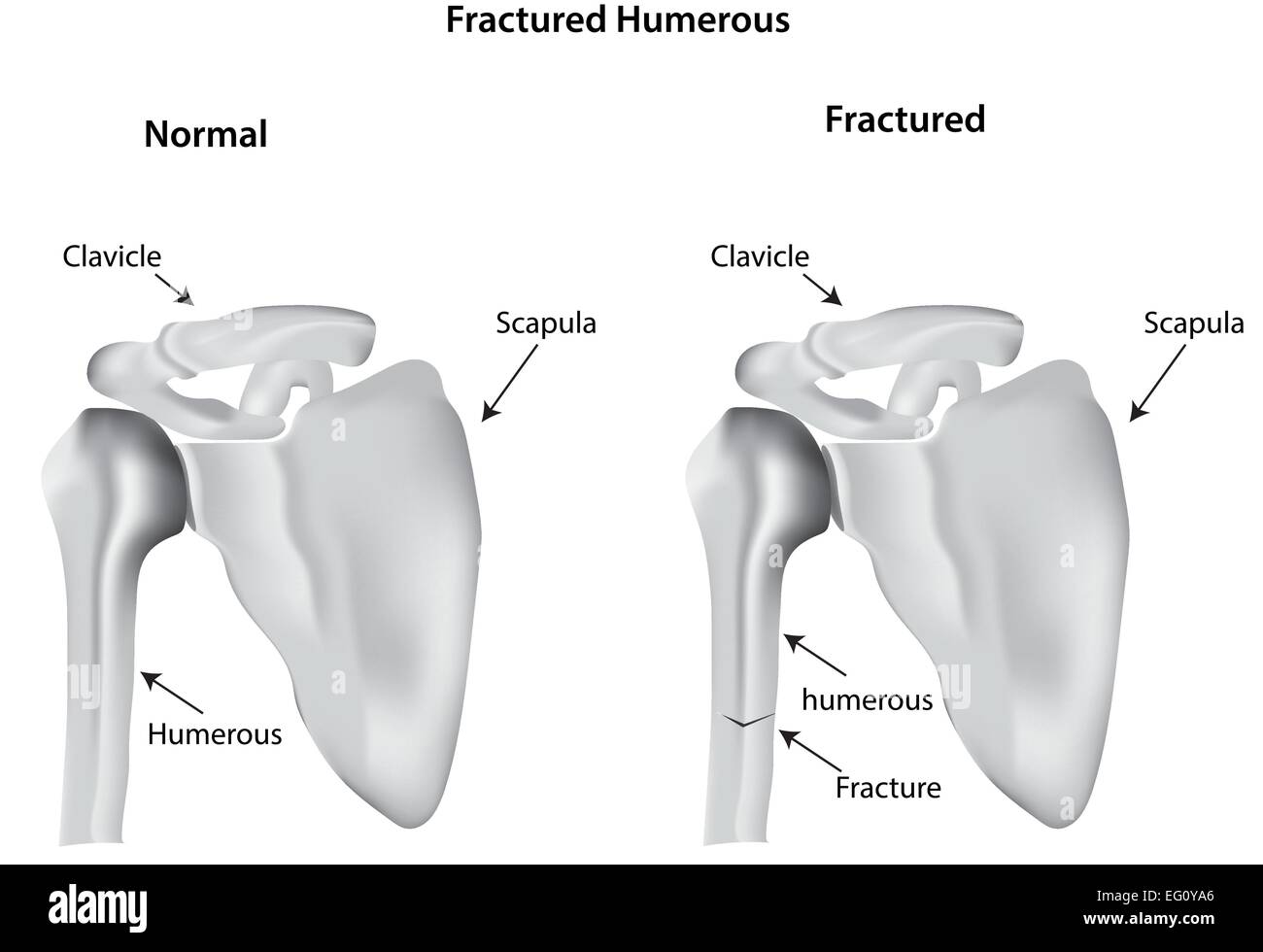 Humerus fracture hi-res stock photography and images - Alamy