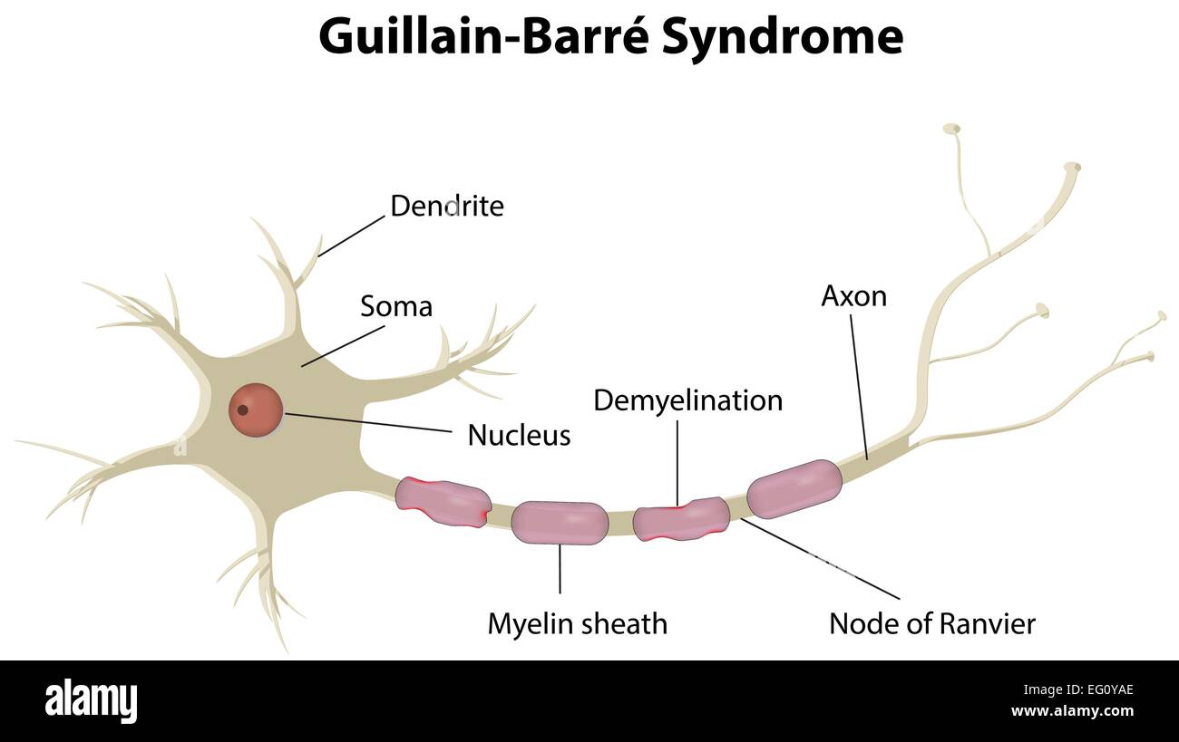 Guillain Barre Syndrome Stock Vector Image & Art - Alamy