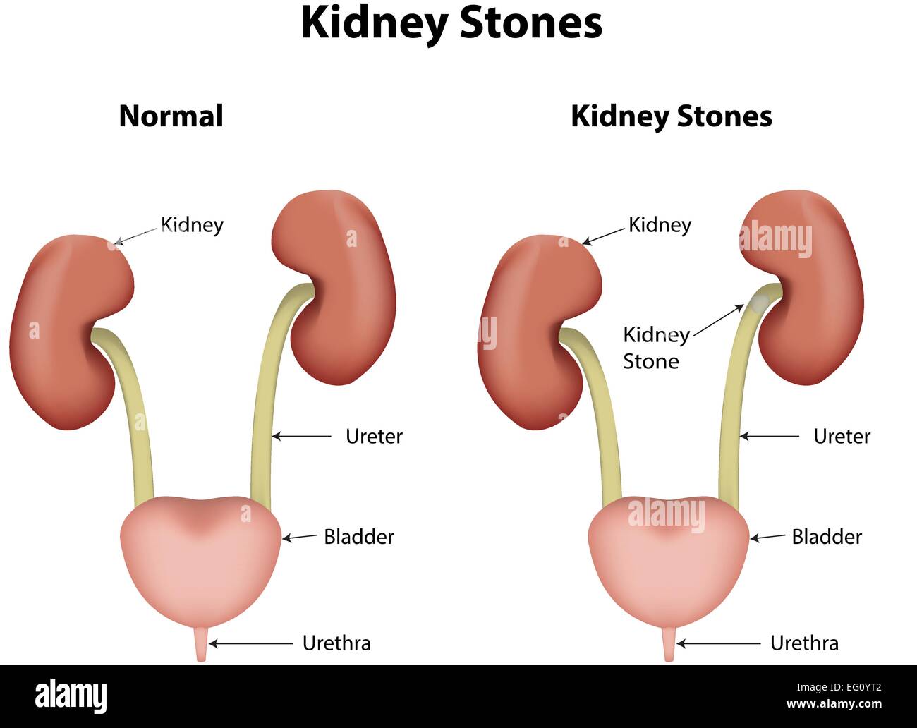Urinary stones Stock Vector Images - Alamy